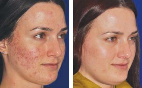 Microneedling - Yorba Linda Dermatology