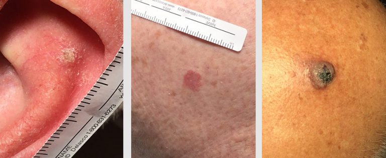 Basal Cell & Squamous Cell Skin Cancers - Yorba Linda Dermatology